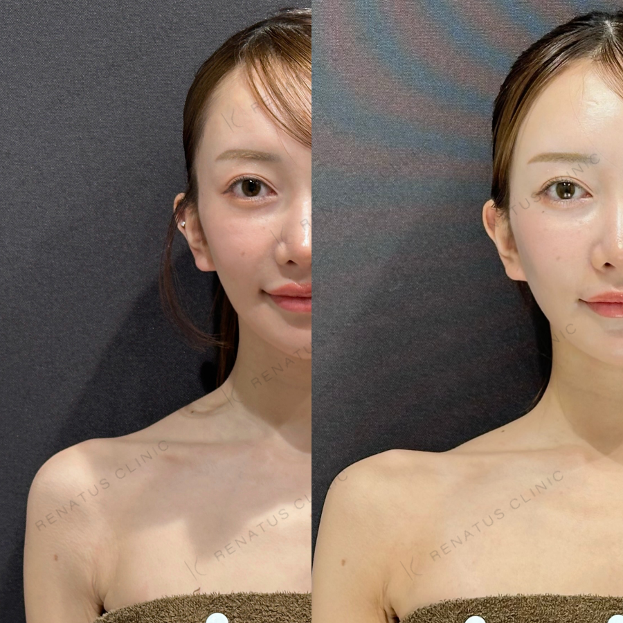 肩ボトックス200単位、2回注入後の症例写真レポート経過動画 | レナトゥスクリニック新宿院